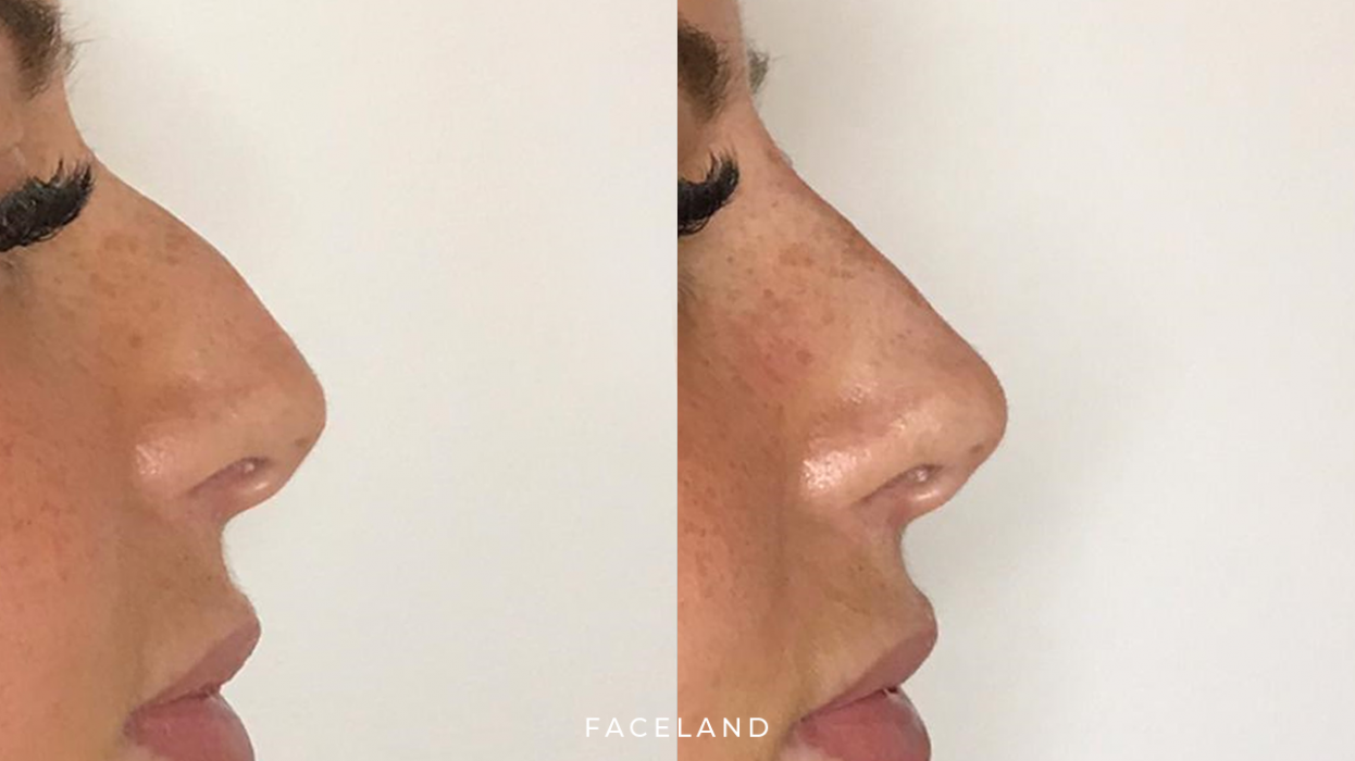 Neuscorrectie met fillers en botox vanaf €350 | Face your beauty |Faceland