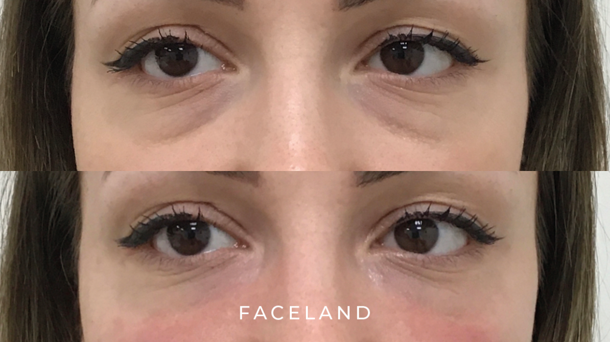 Traangoot filler voor €390,- | Faceland | Face your beauty