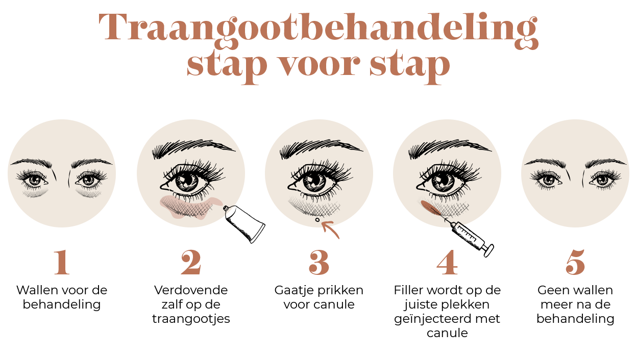 Traangoot filler voor €390,- | Faceland | Face your beauty