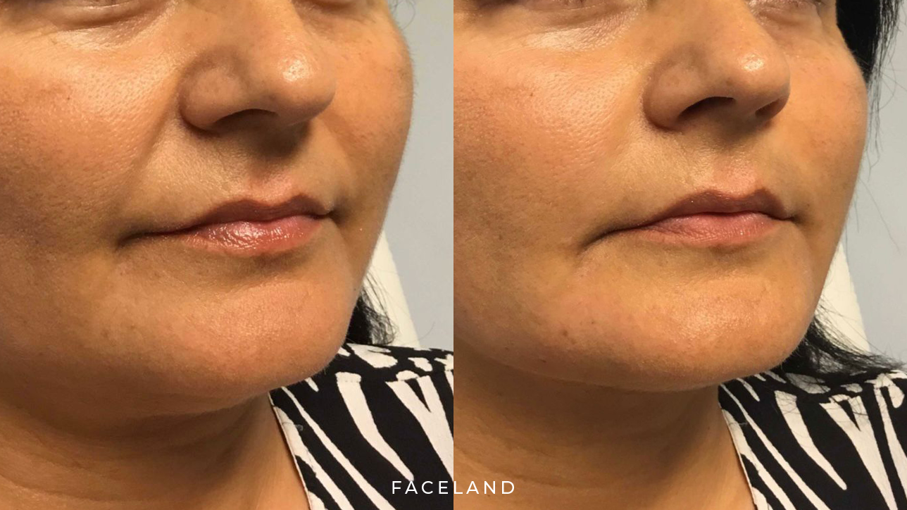 Traitement du sillon nasogénien à l'acide hyaluronique à partir de €170 ...